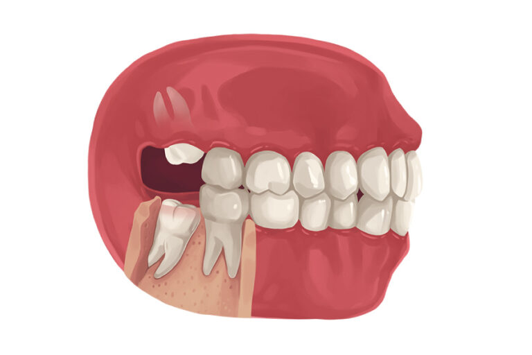 Why Are Some People Born Without Wisdom Teeth? - Flower Mound, TX